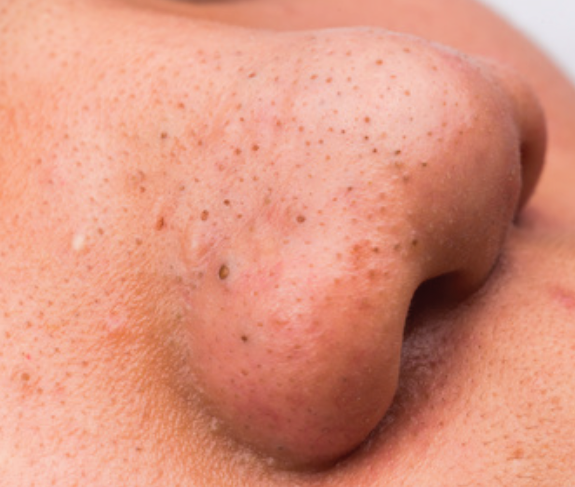 Mitesser DAUERHAFT loswerden! (Anleitung)